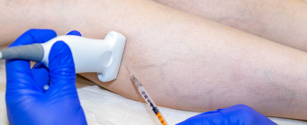 Skleroterapia: informacje i specjaliści. Zarezerwuj Wizytę Online ...